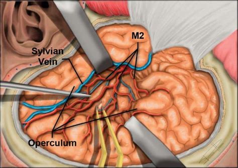 Illustration Of The Transsylvian Approach For Resection Of The Insular Download Scientific