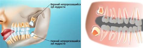 Удаление зуба мудрости без боли Люберцы