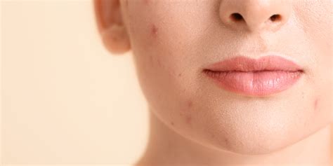 Everything You Need To Know About Hormonal Acne Curology
