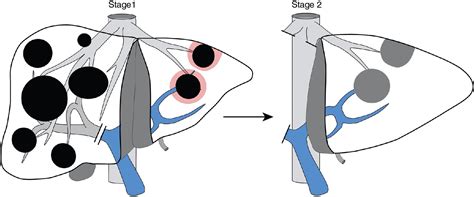 Associating Liver Partition And Portal Vein Ligation For Staged Hepatectomy Alpps Techniques