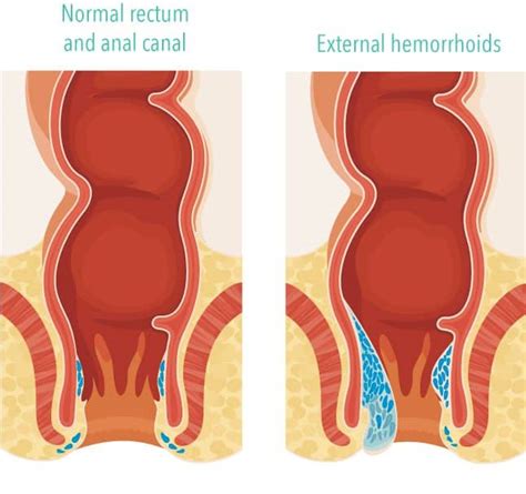 Hemorrhoids During Pregnancy Safe Tips Tricks And Treatments