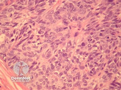 Aggressive Digital Papillary Adenocarcinoma Pathology Image