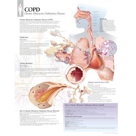Scientific Publishing Chronic Obstructive Pulmonary Disorder Chart