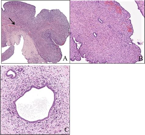 Müllerian Adenosarcoma With Sarcomatous Overgrowth And Heterologous Elements A Case Report And