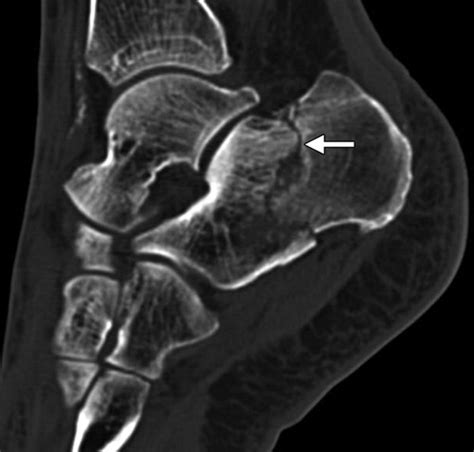 Multidetector Ct Evaluation Of Calcaneal Fractures Radiographics