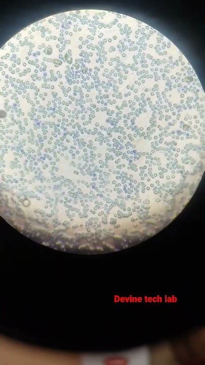 Seen To Reticulocyte Count Youtube