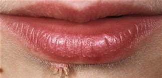 Flat Warts Plastic Surgery Key