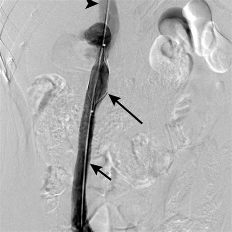 Venography Through The Right Jugular Approach Shows The Dilated Right Download Scientific