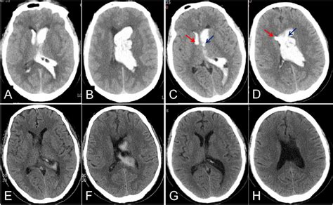 the optimal placement of evd catheter was shown by the ct scan ivh was