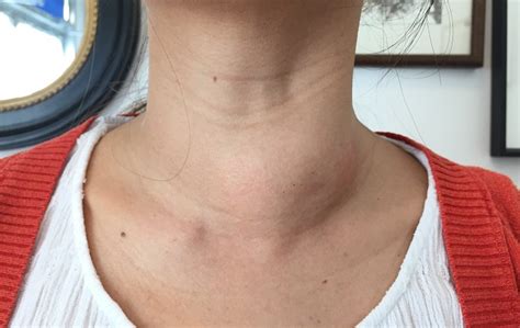 Multinodular Goiter Symptoms Diagnosis And Treatment Scope Heal