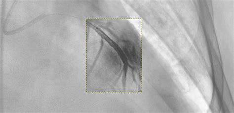 Stent Enhancement Image Processing Function Leadtools Sdk Image Processing Functions Help