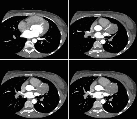 Primitive Neuroectodermal Tumor Of The Pericardium A Case Report And Literature Review Pmc