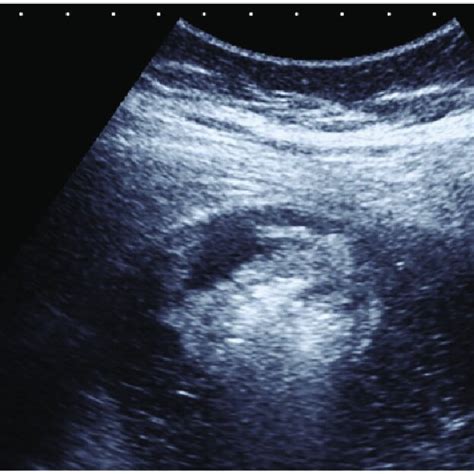 Ultrasound Demonstrating Gradual Resolution Of The Acoustic Shadowing