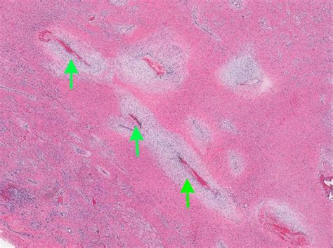 Juvenile Nasopharyngeal Angiofibroma Pathology Outlines