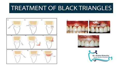 Interdental Papilla Reconstruction