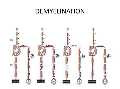 Approach To Polyneuropathy Pptx