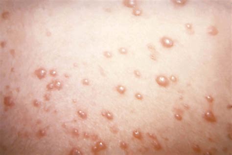 Early Stages Of Adult Chicken Pox