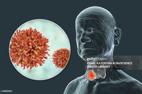 Thyroid Gland Cancer Illustration High Res Vector Graphic Getty Images