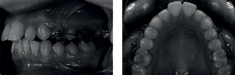 Figure 1 From Intermittent Orthodontic Force Should Always Be Considered When There Is A Higher