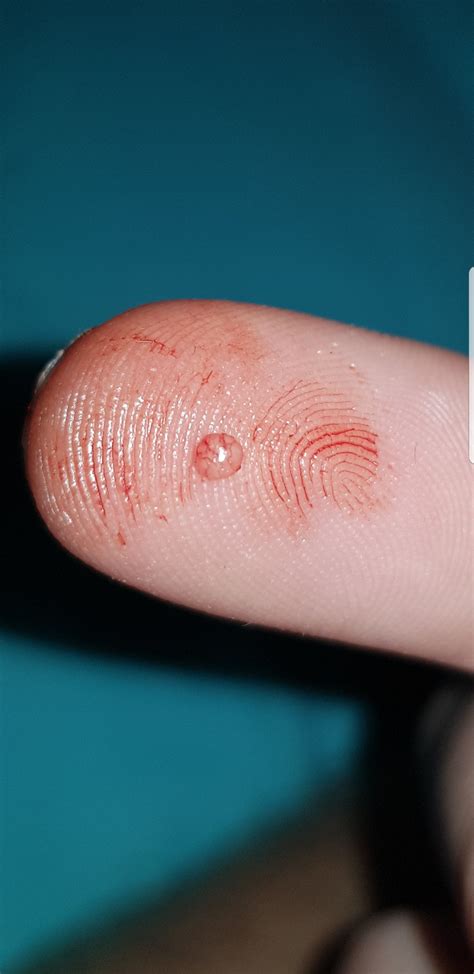 What Did I Remove From My Leg Askdocs