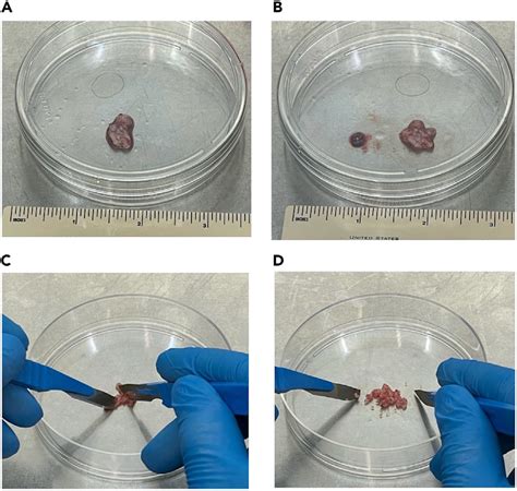 Mincing Of Human Head And Neck Tumor Tissue A Initial Tumor Sample