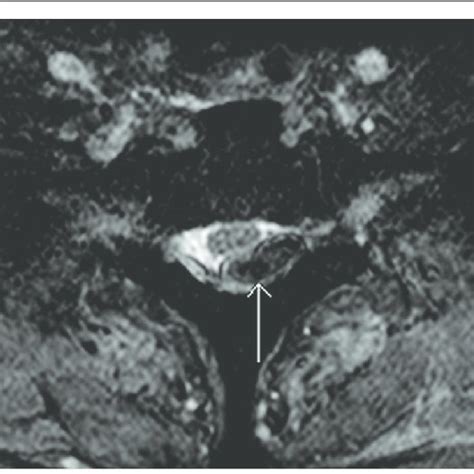 Axial Gradient Recalled Echo Gre Image A And Sagittal T1 Weighted Download Scientific