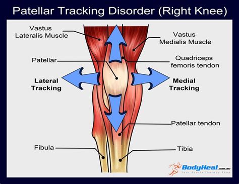 18 Best Patellar Tracking Disorder Images On Pinterest Workouts Physical Therapy And Exercise