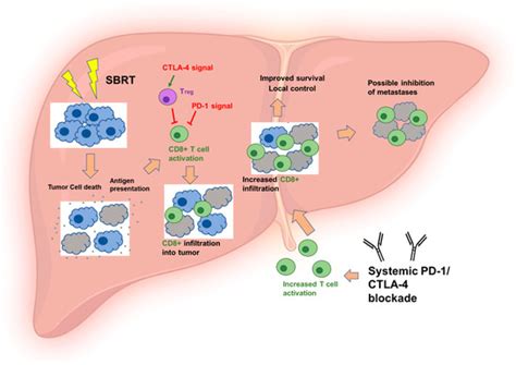 Cancers Free Full Text Stereotactic Body Radiation Therapy SBRT