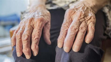 Simple Frailty Test In Tavr Can Help Decide Not Just ‘if But ‘how