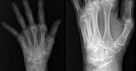 Roentgen Ray Reader Hemochromatosis Hand Manifestations