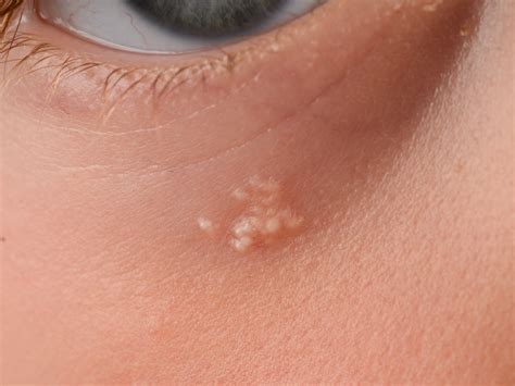 Colloid Milium Pictures Photos