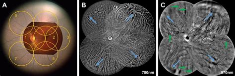A Field Of View Comparison With Fundus Image From Commercial Fundus Download Scientific