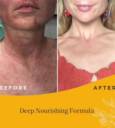 Eyelid Eczema What Is It And Why Do I Have It Satya Organic Canada