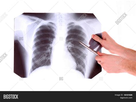 X Ray Image Chest Image And Photo Free Trial Bigstock