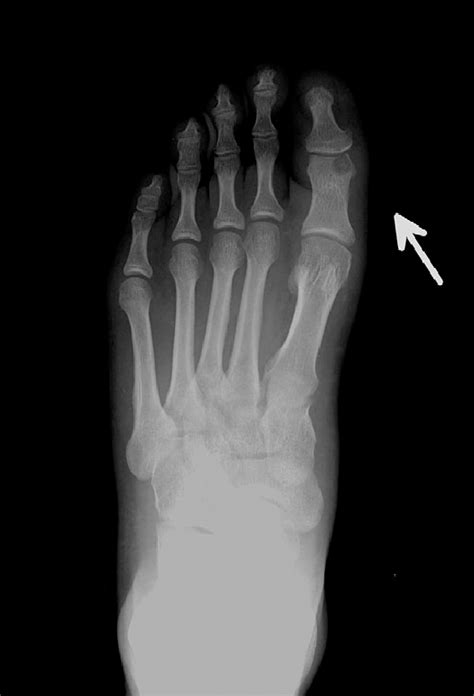 Posterior Anterior X Ray Imaging Of The Left Forefoot Showing An