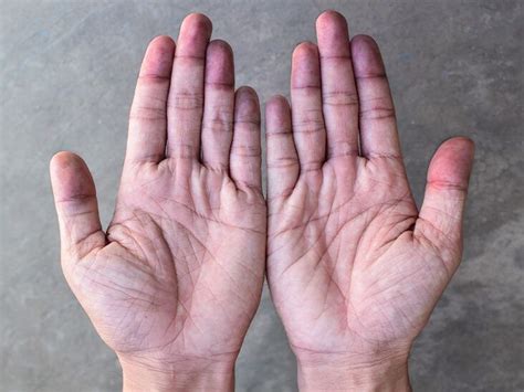 Cyanosis Types Symptoms Causes Treatment More 48 Off