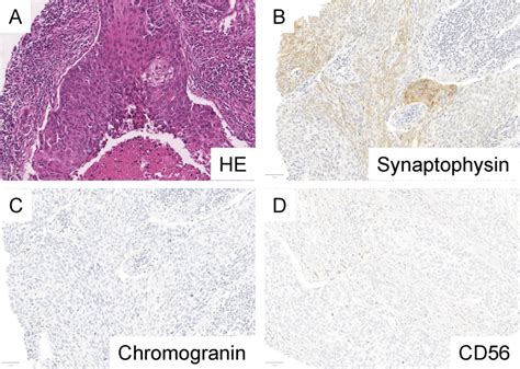 Example Of A Pulmonary Squamous Cell Carcinoma Positive For