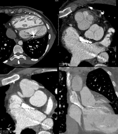 Contrast Enhanced Cardiac Computed Tomography Demonstrating A A