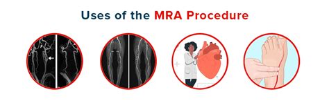 Mra Uses Risks Preparation And Procedure Mra And Mri
