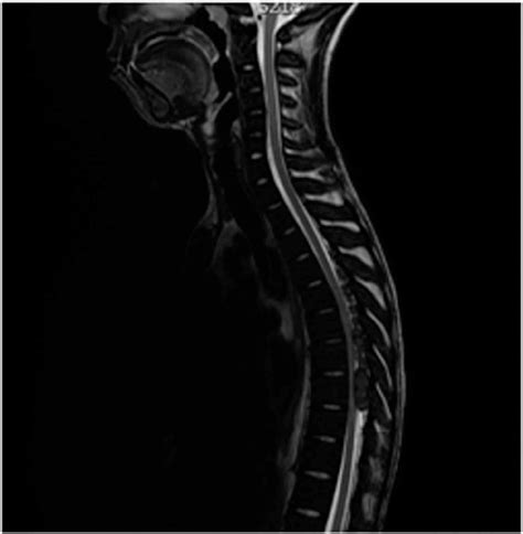 Sagittal T2w Image Showing A Large Epidural Mass Occupying The