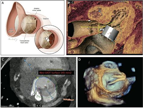 Leaflet Modification In Transcatheter Treatment Of Valvular Heart