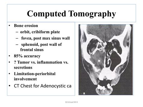 Malignant Tumors Of Paranasal Sinuses Pptx