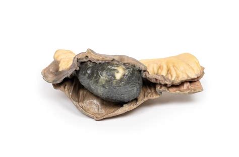 Gall Stone Ileus Australian Physiotherapy Equipment