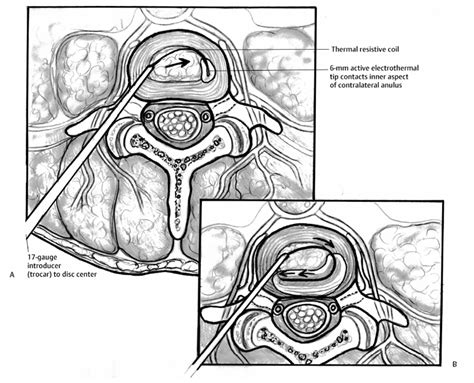 Intradiscal Therapy Neupsy Key