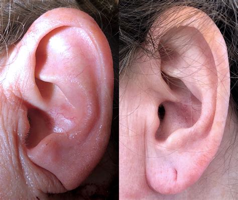 Before And After Photos Earlobe Repair 3 Nyc
