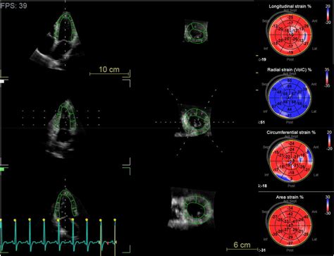 Representative 3d Speckle Tracking Echocardiography For Derivation Of Download Scientific