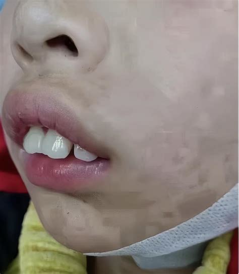 腺样体肥大是保守治疗还是手术？ 知乎