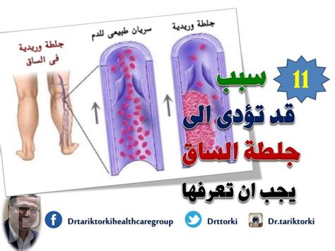 11 سبب قد تؤدى الى جلطة الساق يجب ان تعرفها دكتور طارق تركى مستعمل