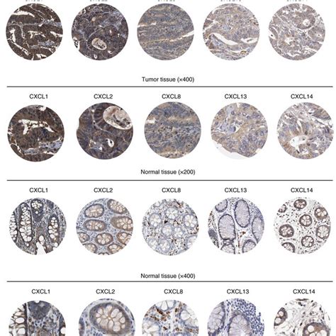 Representative Expression Of Cxcls In Colorectal Cancer Tissues And