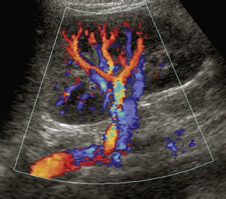 Duplex Ultrasound Of Native Renal Vasculature Radiology Key